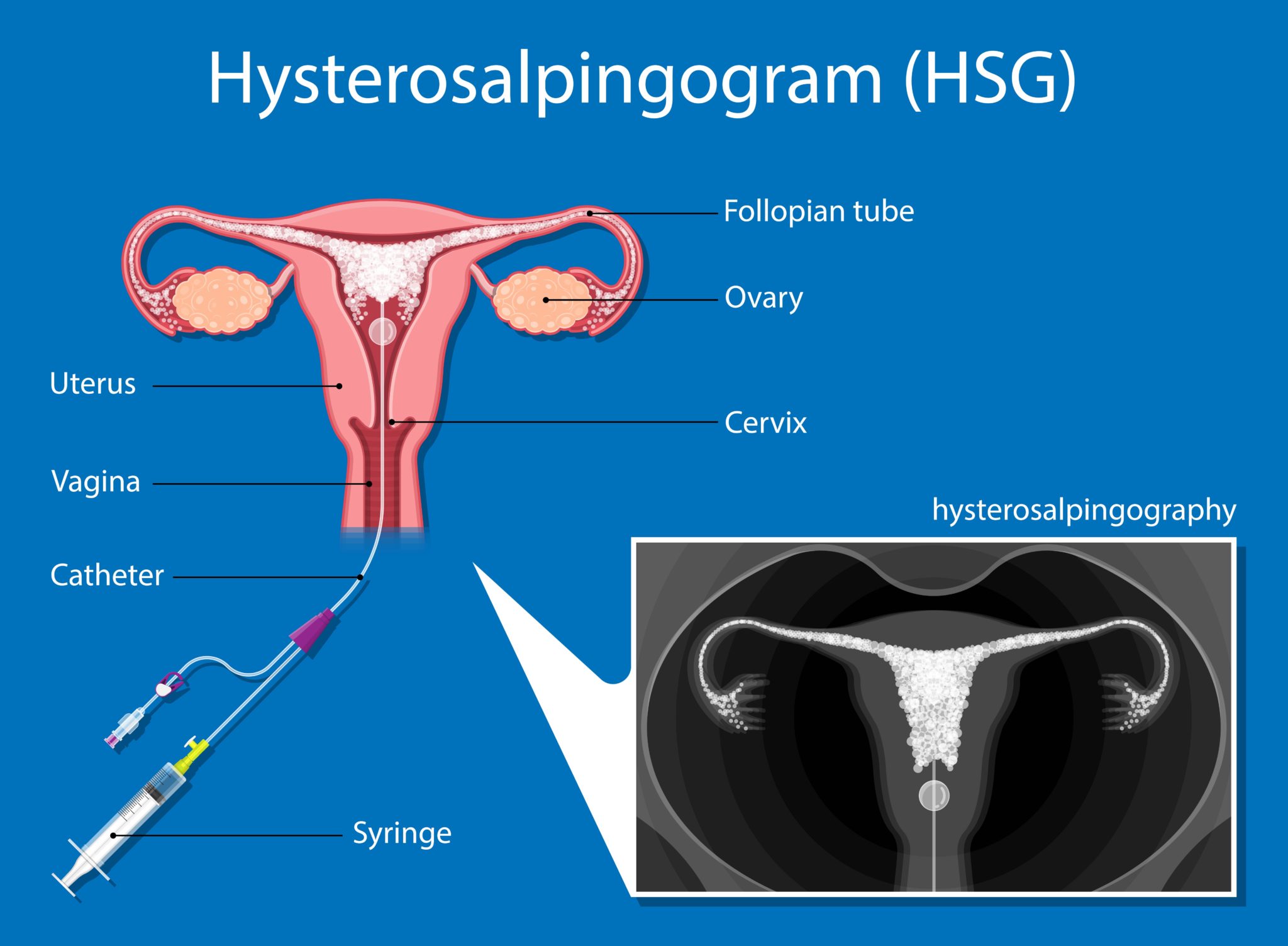 不孕别着急，子宫输卵管超声造影帮助你！福州福兴妇产医院